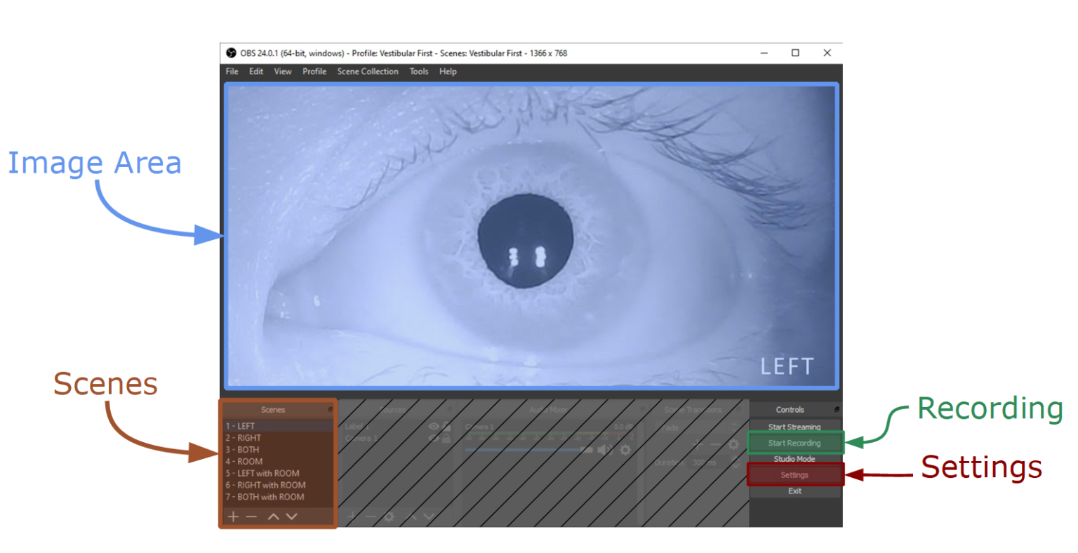 Step 4 - View & Record Session | Vestibular First