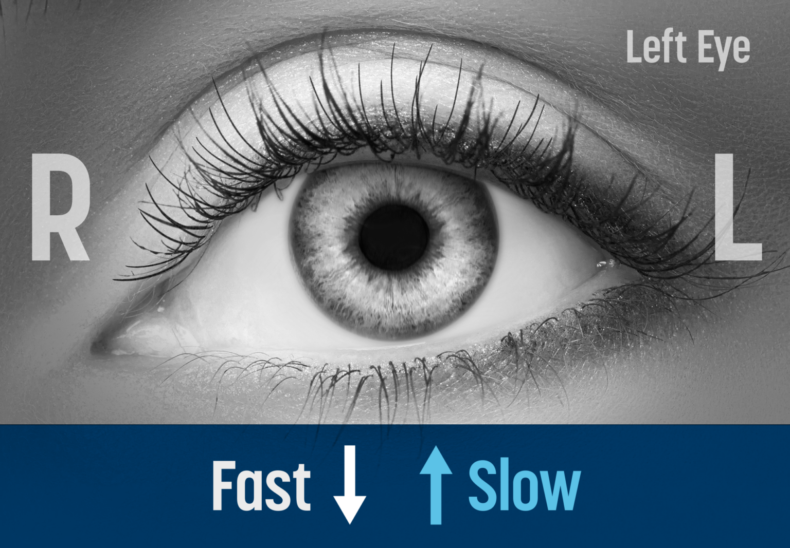 Posterior Canal BPPV | Vestibular First