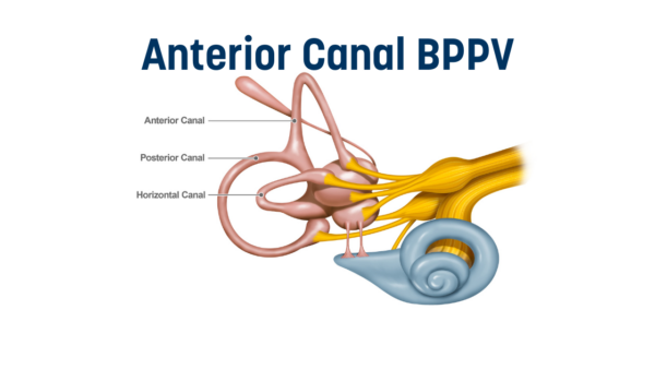 Anterior Canal BPPV - Vestibular First