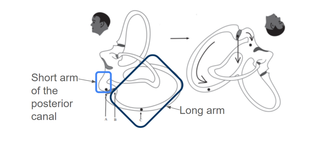 Anterior Canal BPPV - Vestibular First