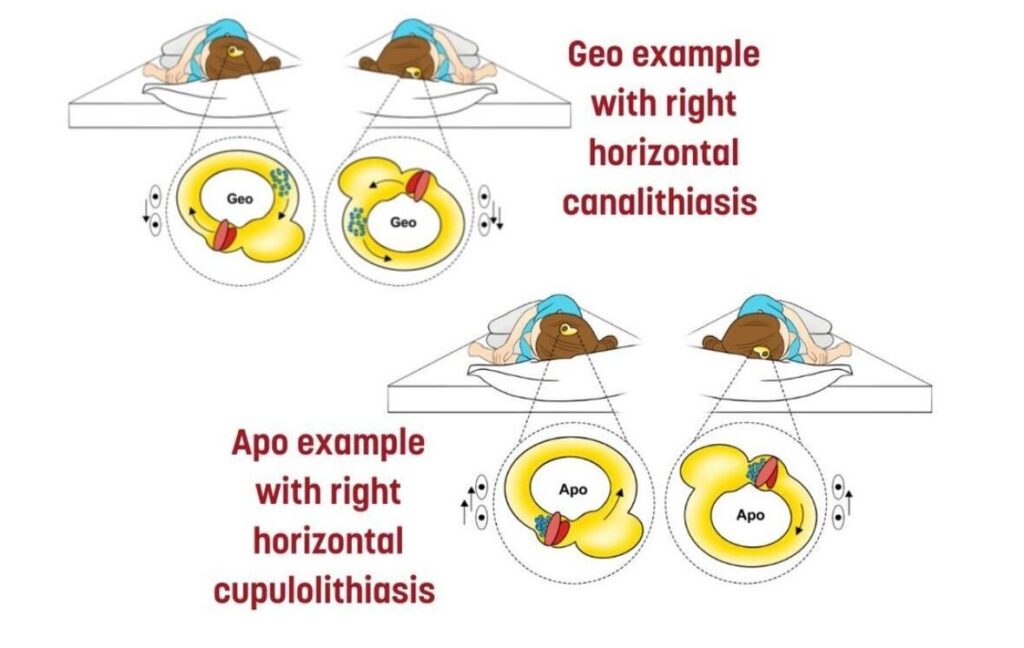 Gufoni Maneuver for Horizontal Canalithiasis | Vestibular First