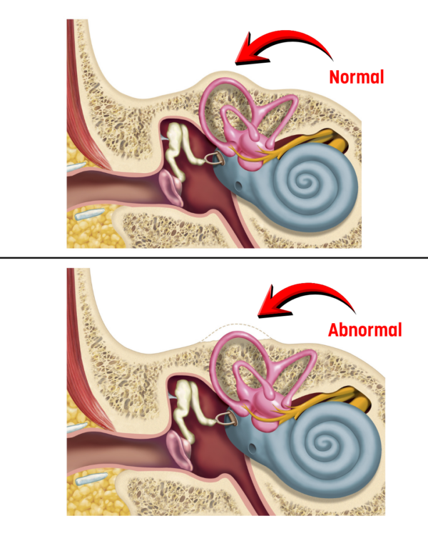 Superior Semicircular Canal Dehiscence (SSCD) | Vestibular First